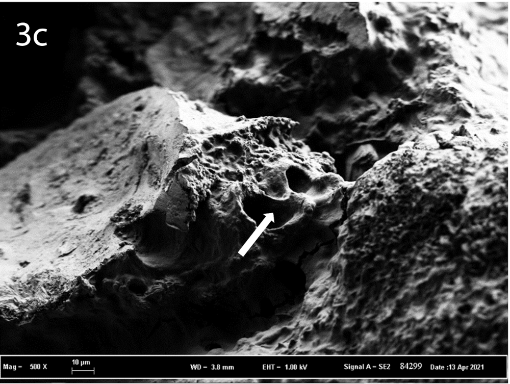 Randall’s plaque as the origin of idiopathic calcium oxalate stone ...