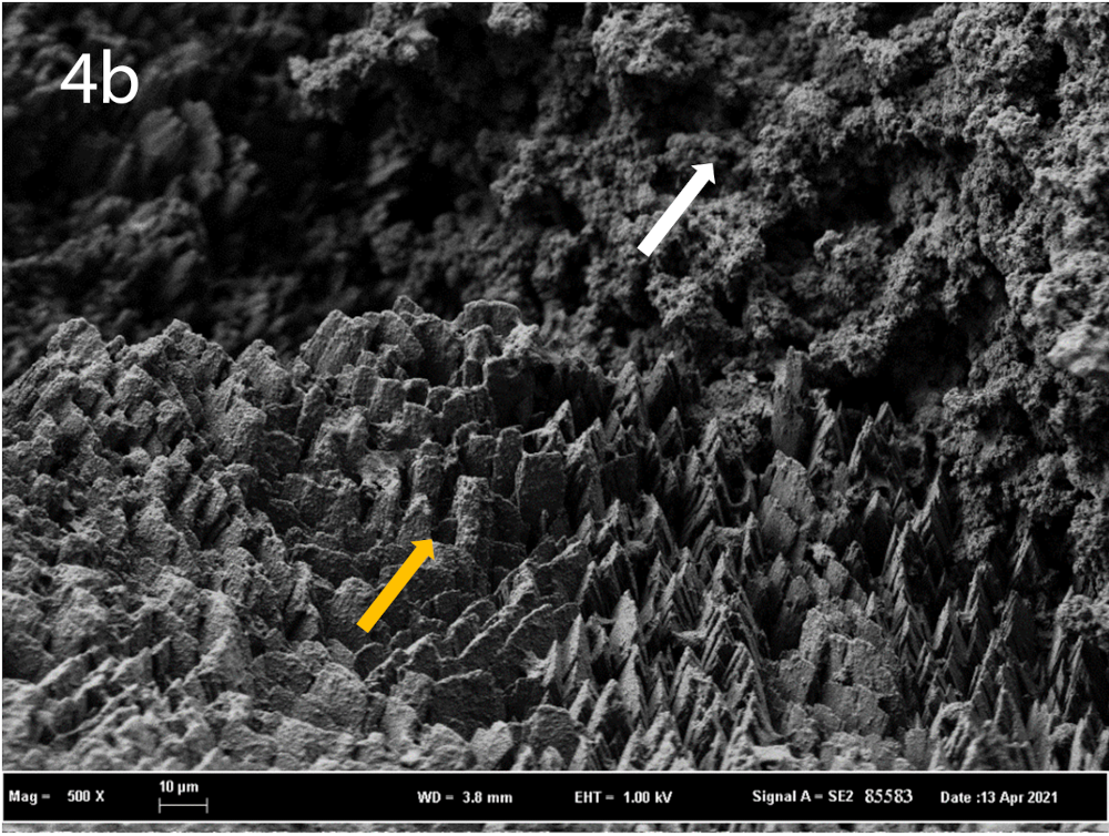 Randall’s plaque as the origin of idiopathic calcium oxalate stone ...